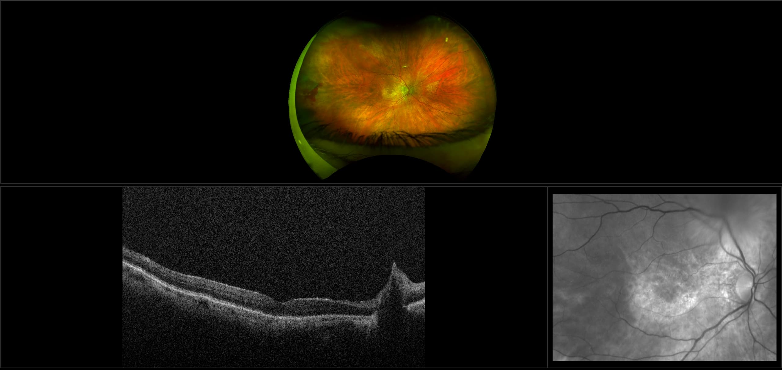 Silverstone - Peripapillary Atrophy, RG, OCT